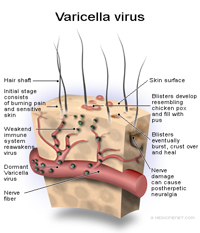Ejema: VARICELA