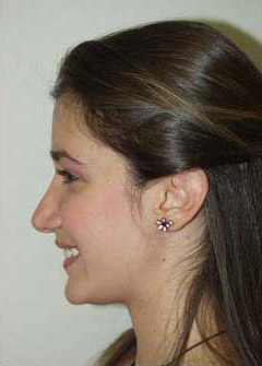 Health and Beauty - Living life healthier: Nasofix Review - Before and ...