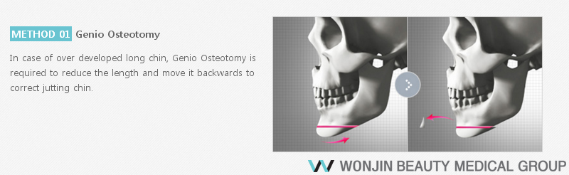 Korea Two Jaw Surgery Wonjin Beauty Medical Group - Jutting Jaw ...