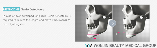 Korea Two Jaw Surgery Wonjin Beauty Medical Group - Jutting Jaw ...