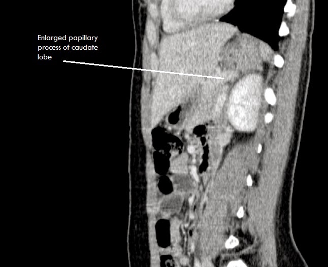 Ultimate Radiology : Pseudolesion : Papillary Process of Caudate Lobe