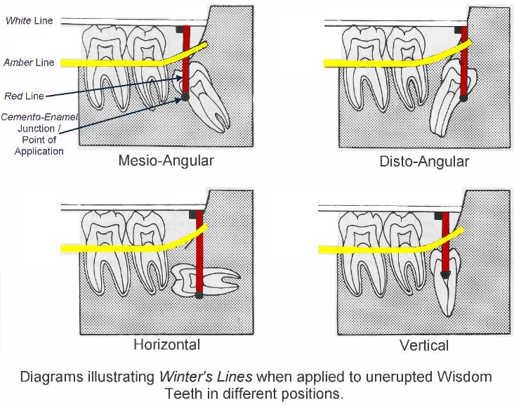 Impacted Mandibular 3rd Molar Classification, Complications ...