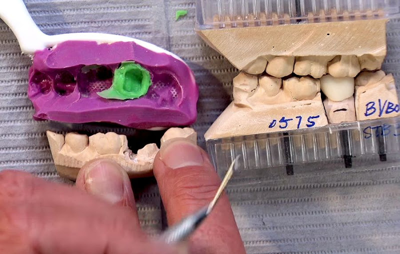 DENTAL IMPRESSION: Examining an Impression with Overly Tall and Wide ...