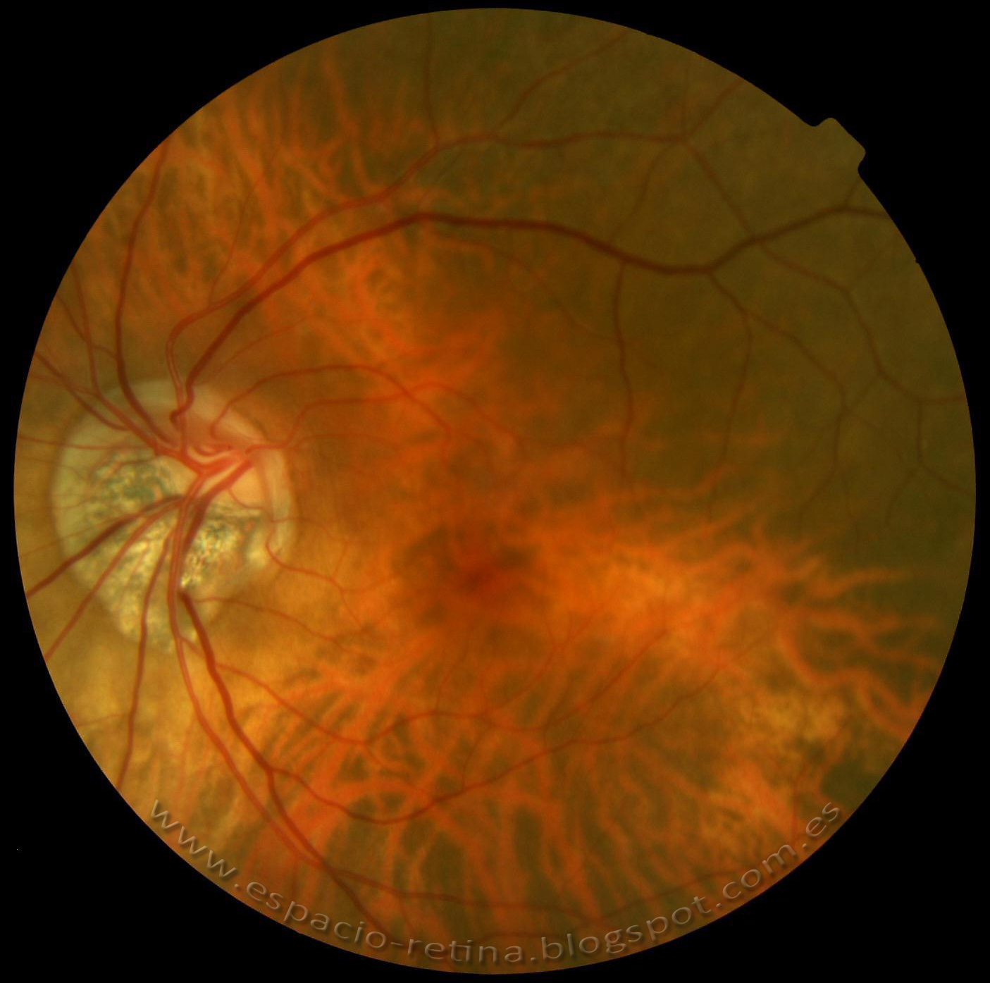 ESPACIO RETINA: Foseta de la papila.