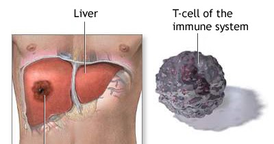 Abses Hepar - CatatanDokter