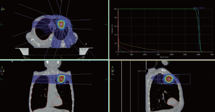 Lung Cancer: Treatments For Lung Cancer Stage 3