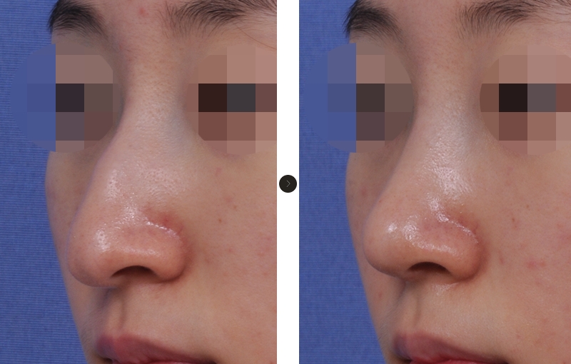Best Nose Job Clinic In Korea Korean Hooked Nose Job