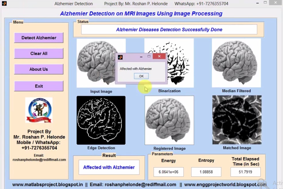 Alzheimer Detection on MRI Images Using Image Processing Matlab Project ...