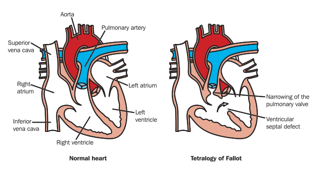 Real Ryan: Tetralogy of Fallot Facts