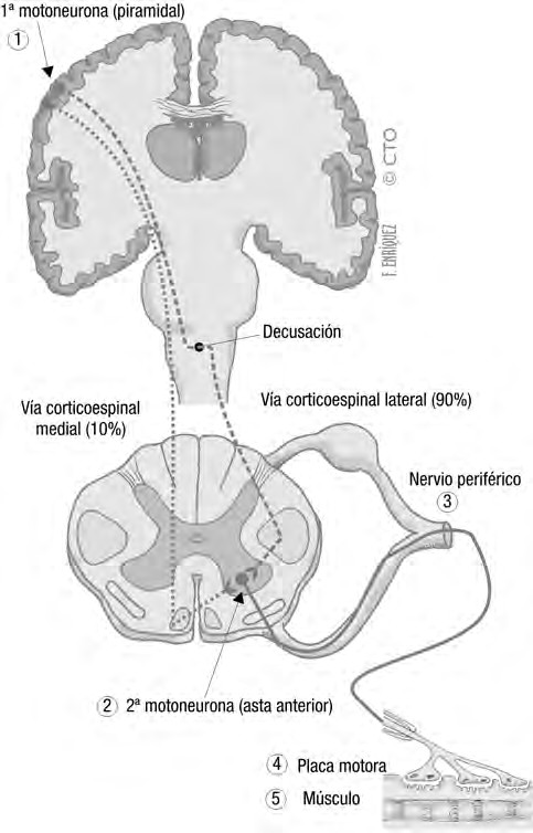 RESPUESTAS DESGLOSES: NEUROLOGÍA, P238 MIR 2000-2001