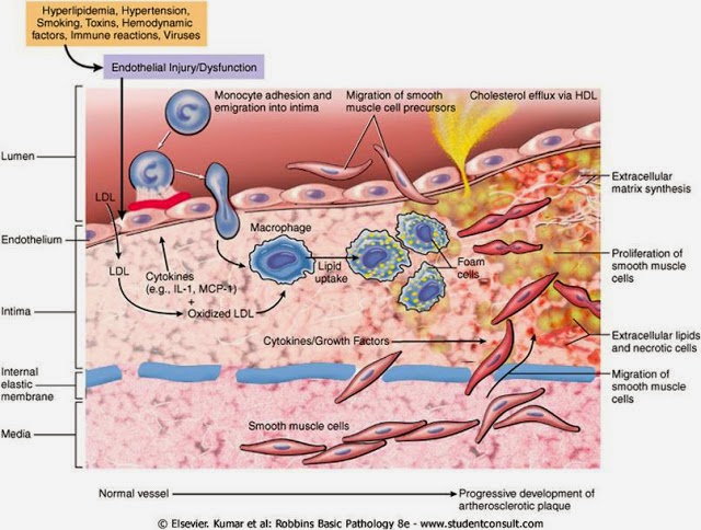 Patologia B: Fisiopatología de la placa de ateroma