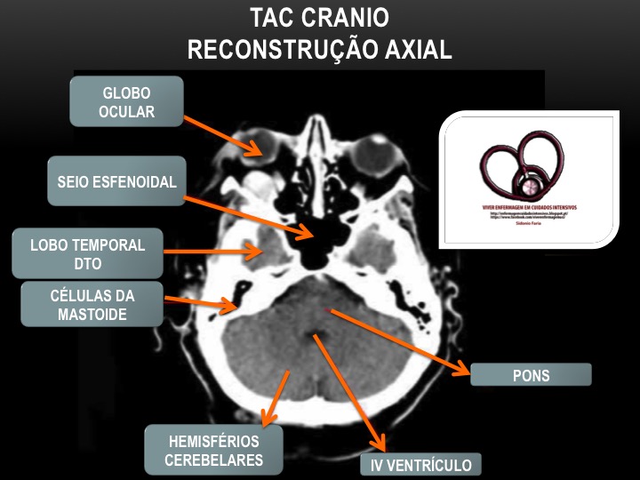 Viver Enfermagem em Cuidados Intensivos: TAC DE CRANIO... VISUALIZANDO ...