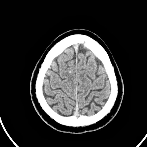 Ultimate Radiology : Multiple Cavernomas in Brain