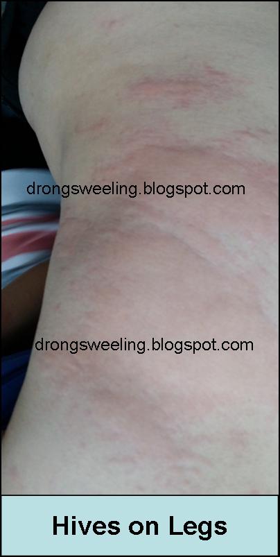 TCM News: TCM Doctor Treatment for Hives, Urticaria