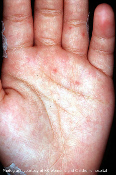 HFMD - Hand, Foot, Mouth Disease - Health Tips