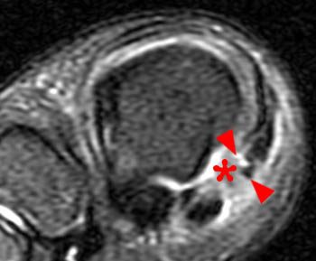 MRI Musculo-Skeletal Section: Turf toe.