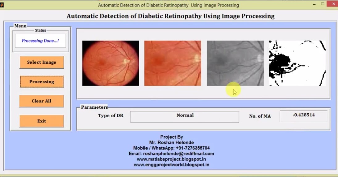 Detection Of Diabetic Retinopathy In Fundus Images Using Neural Network