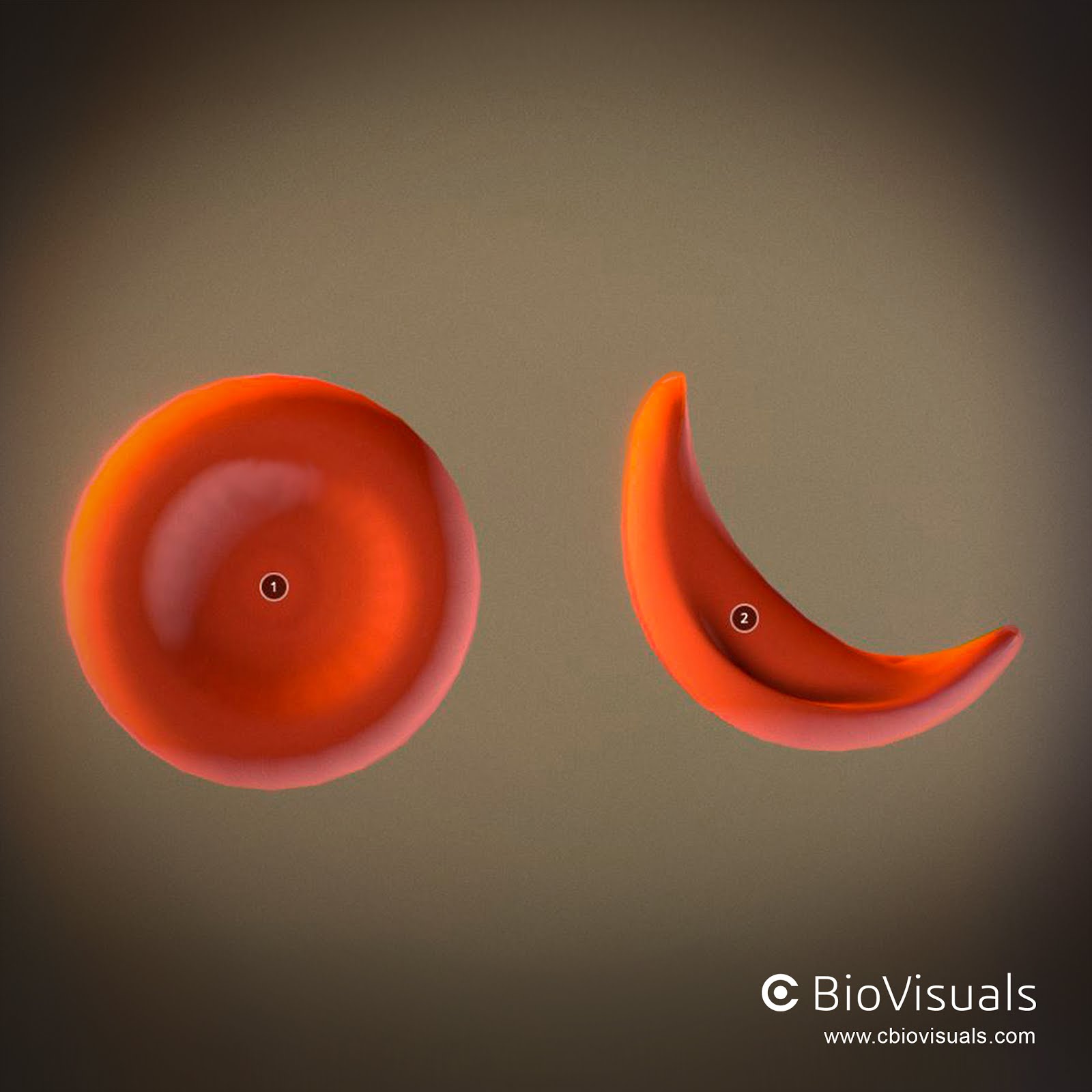 RBC Functional Deformation | Sickle Cell Disease 3D Interactive Model