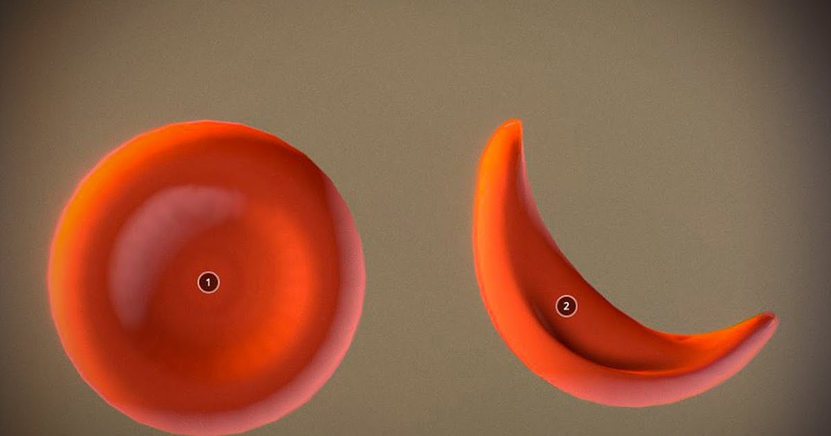 RBC Functional Deformation | Sickle Cell Disease 3D Interactive Model