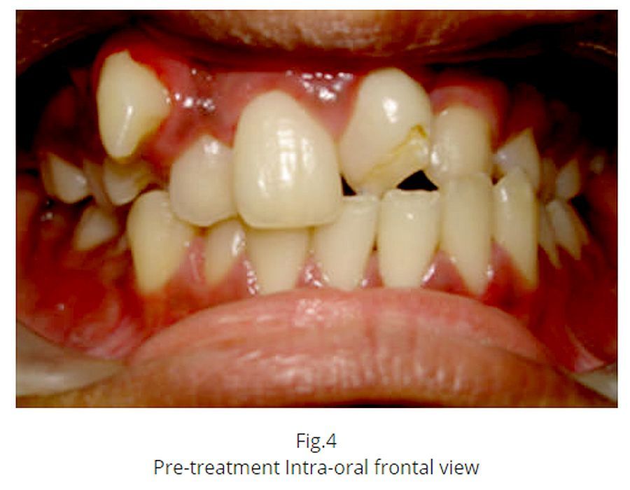 Orthodontic management of a cleft patient: A case report