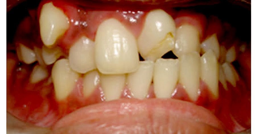 Orthodontic management of a cleft patient: A case report - Ovi Dental