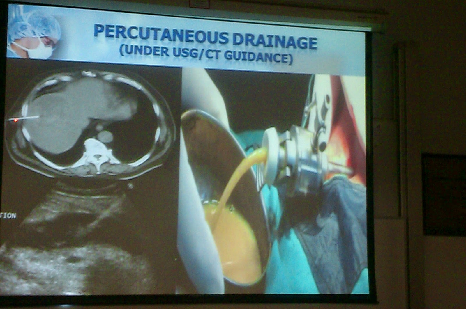 Lecture Slides; surgery: Liver Abscess