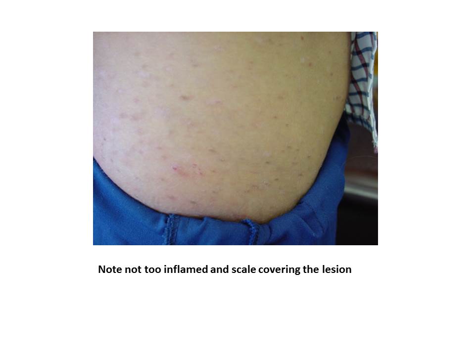 Consultations in Dermatology: Pityriasis Lichenoides PLEVA