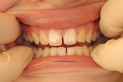 The Endo Blog: Internal bleaching makes us smile!