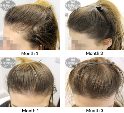 Overcoming Female Pattern Baldness