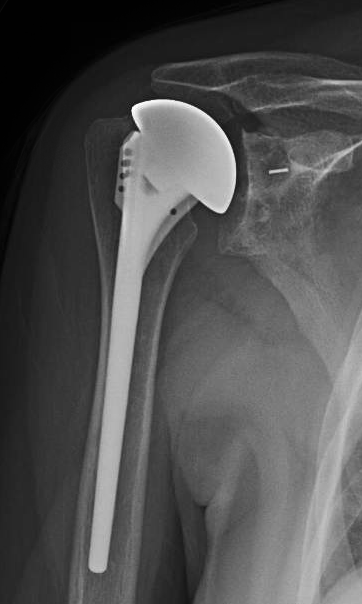 UW Shoulder and Elbow Academy: Addressing glenoid retroversion in total ...