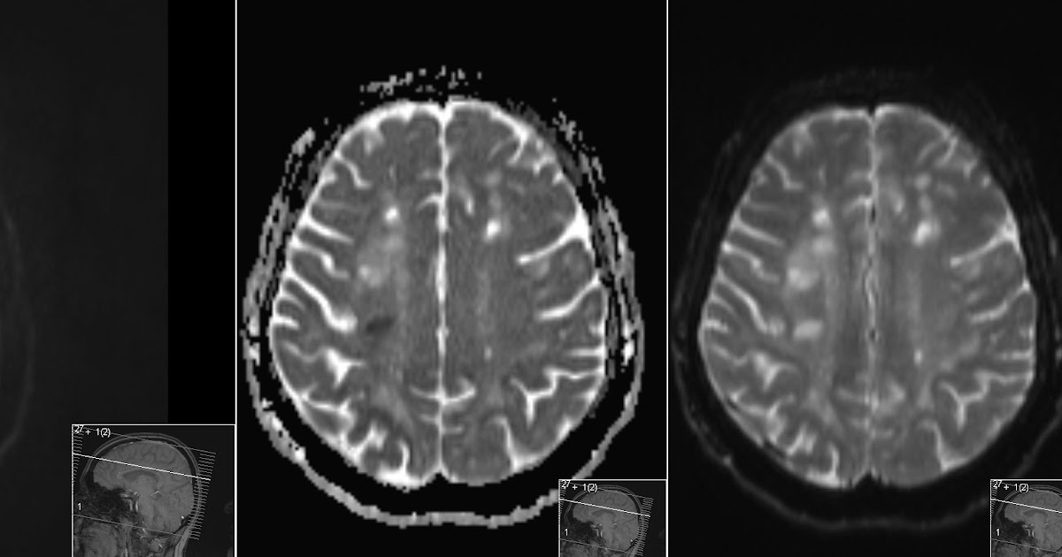 Radiology MRI: DWI Restriction in MS
