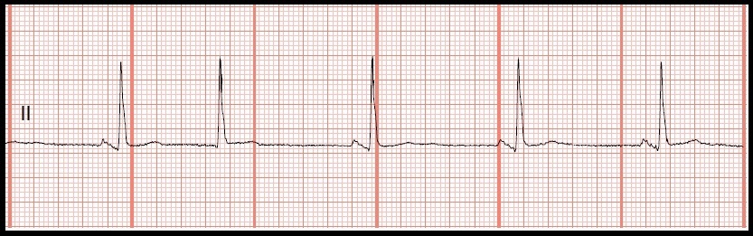 EKG Rhythm Strip Quiz 141