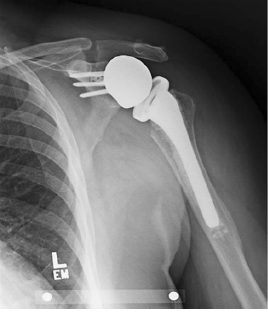 UW Shoulder and Elbow Academy: Reverse total shoulder - safe baseplate ...