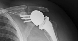 UW Shoulder and Elbow Academy: Reverse total shoulder - safe baseplate ...