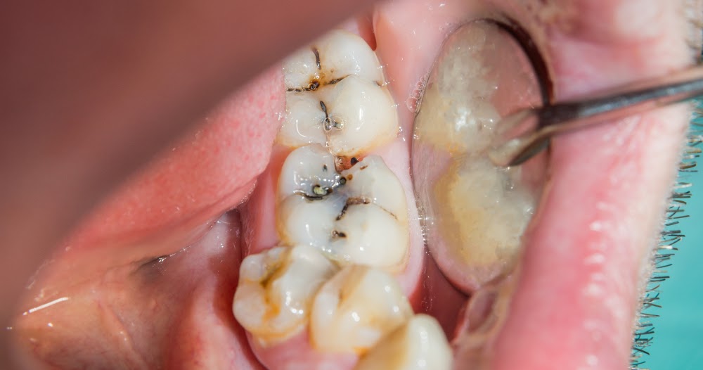 Redefining the Future of Health Services: Hyperdontia Causes Symptoms ...