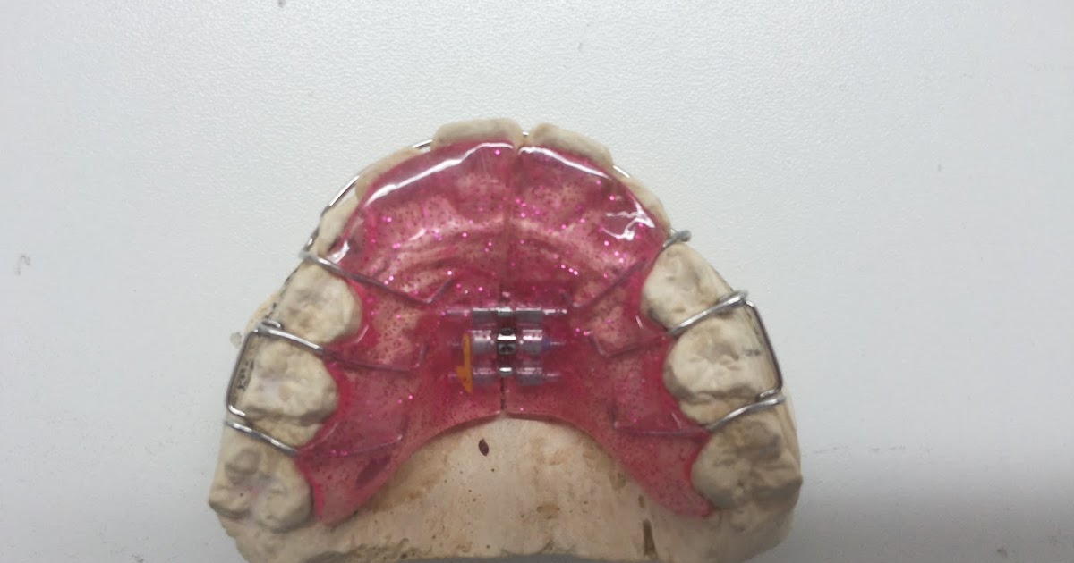 Ortobella: Aparelhos de expansão com arco de hawley.(batente anterior ...