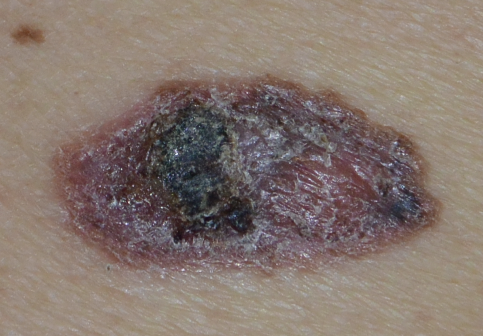 Derma-Docència Castelló: Melanoma: 8 de cada 100.000