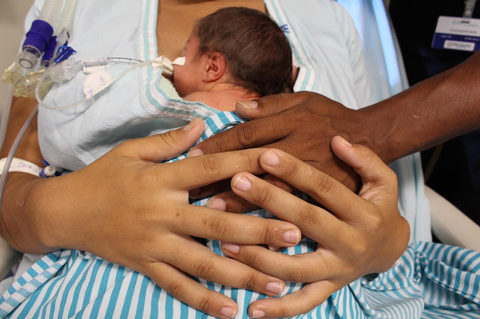 Canguru é realizado pela primeira vez em prematuro intubado no HMIB ...