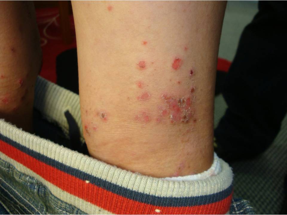 Consultations in Dermatology: The Rash that itches - Atopic Dermatitis