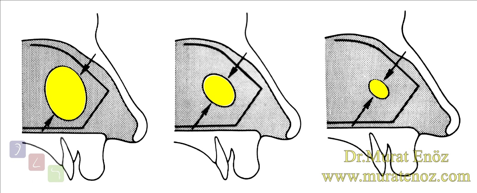 We Performed Extracorporeal Septum Perforation Repairing Surgery!