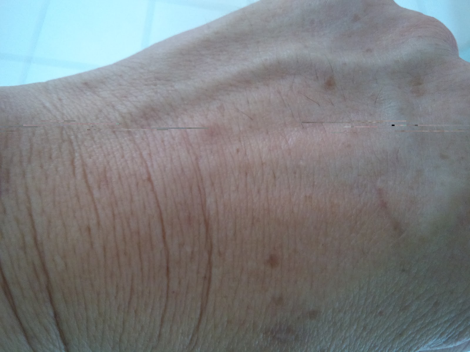 I Live In KK: Old Age Spot/Liver Spot