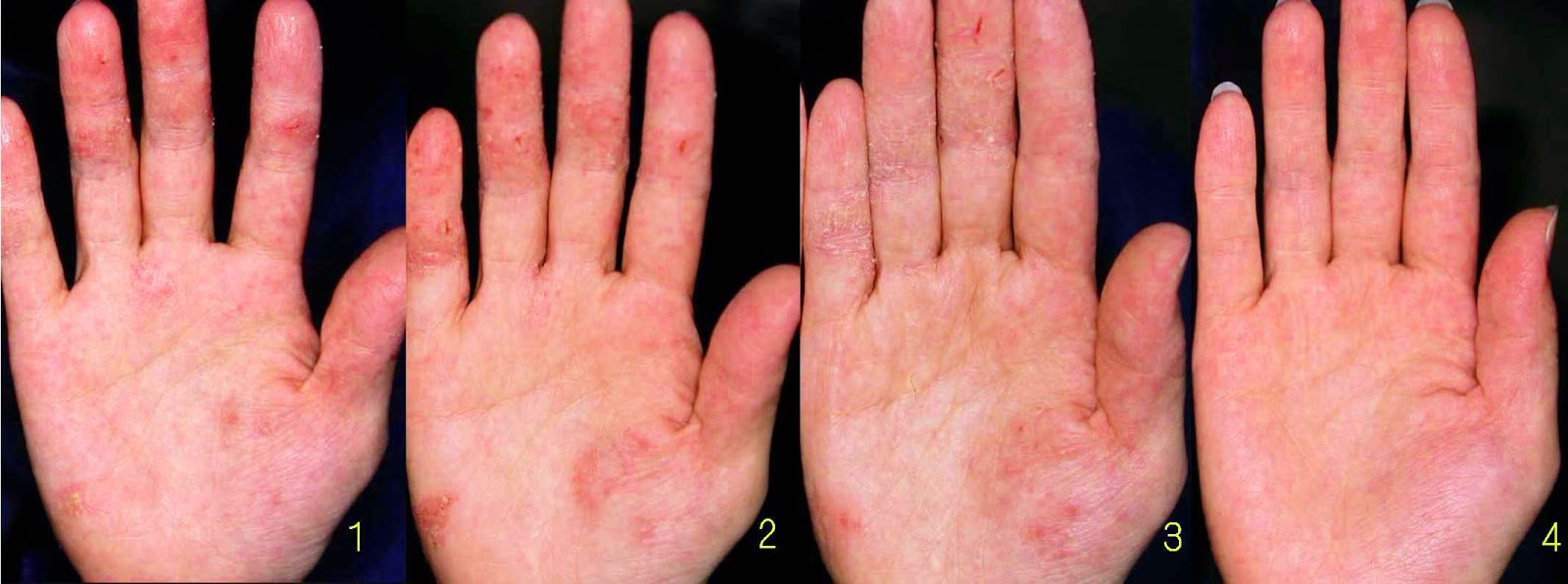 DERMATITIS ~ dr Ainil Masthura