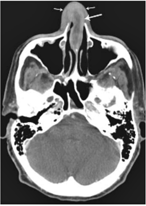 lemon tea and cookies: REFERAT ABSES SEPTUM NASI