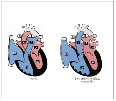 Keeping Up With The Pace - By Grace Davitt: 'Congenitally Corrected ...