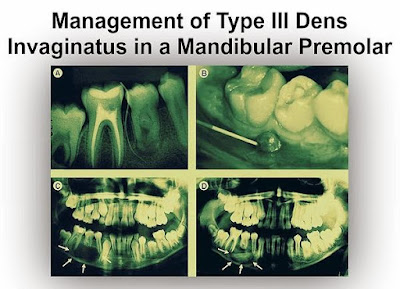PDF: Management of Type III Dens Invaginatus in a Mandibular Premolar ...