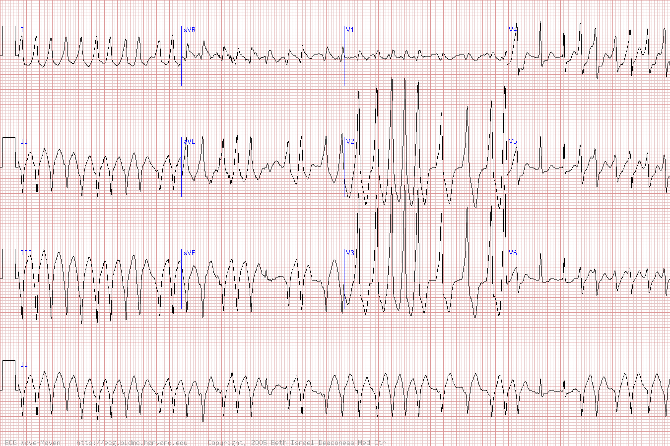 Doc Cottle's Desk: Procainamide - Hipster drug, or too mainstream?