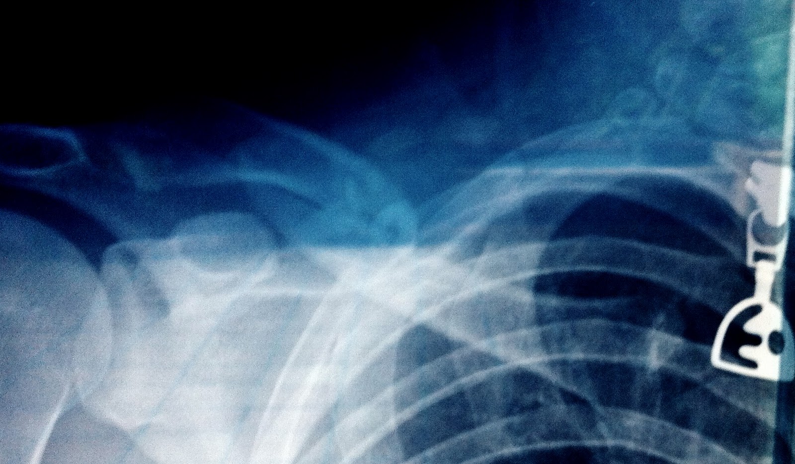 Pep Tatché: Clavícula Trencada. Clavícula Rota.