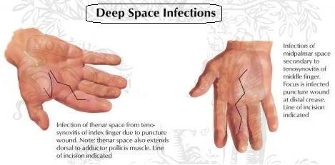 Hand infection