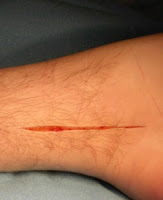 Wound Home management. ~ akufisio.blogspot