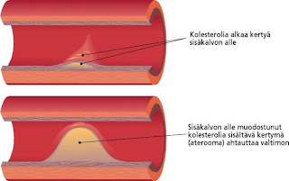 .: Kolesterolidebaatti – Osa 1: Famiaalinen hyperkolesterolemia